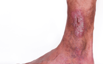 USA’s Best Vein Treatment Center | Visit United Vein Centers